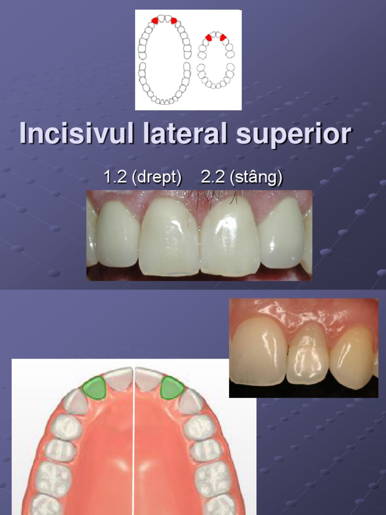 Incisivul lateral superior | PDF