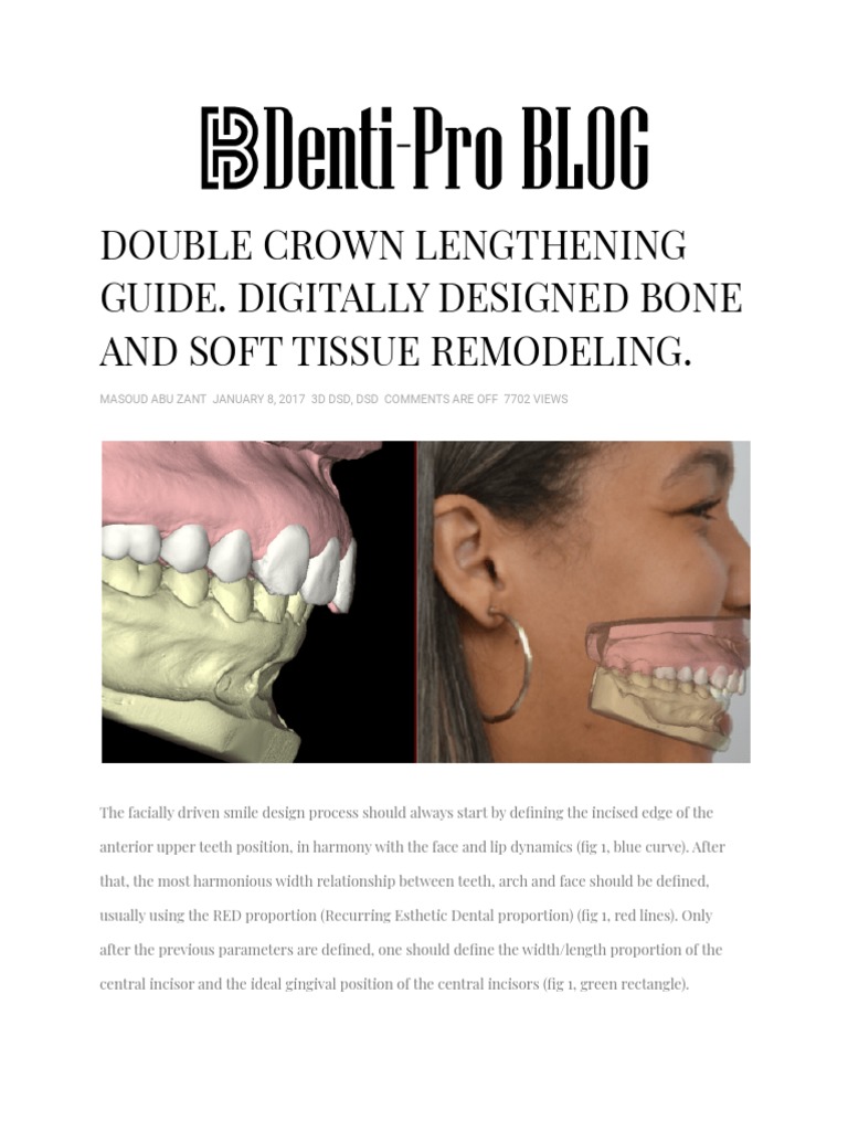 DOUBLE CROWN LENGTHENING GUIDE. DIGITALLY DESIGNED BONE AND SOFT TISSUE ...