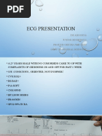 Delta Wave - LITFL Medical Blog - ECG Library Basics | PDF | Cardiac ...