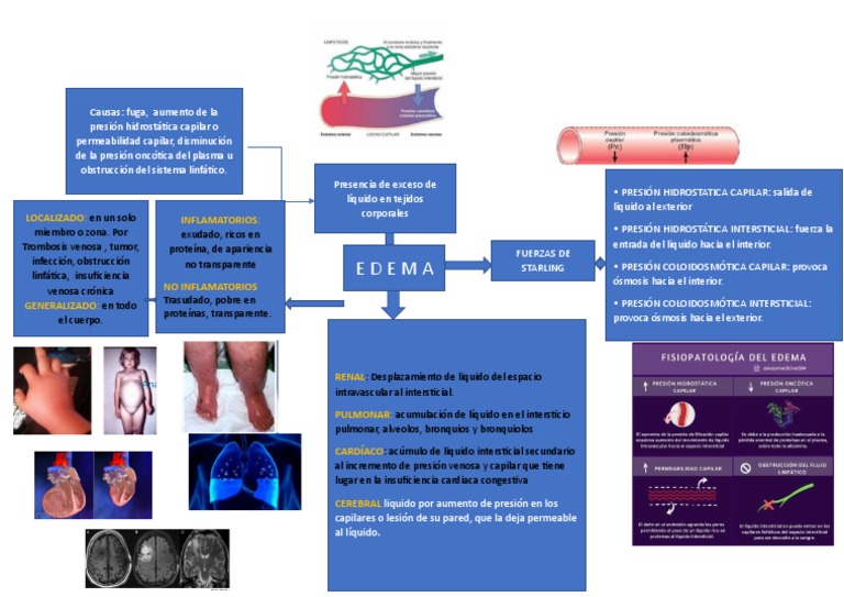 Mapa Mental Edema-1 | PDF