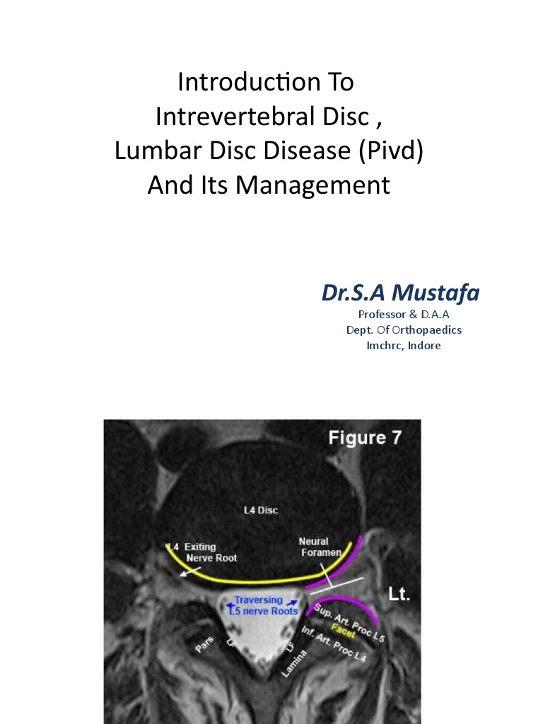 Intervertebral-disc-Anatomy-And PIVD of Lumbar Final | PDF