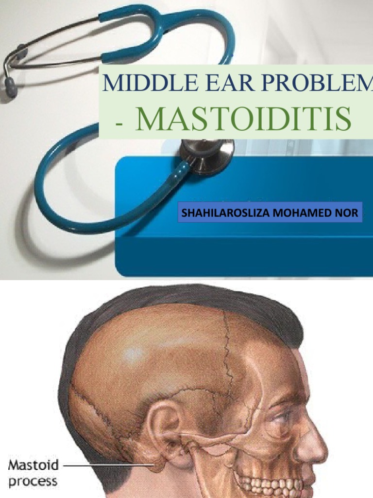 SN Mastoiditis - Ent | PDF