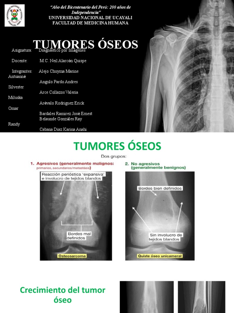 Túmores Óseos Expo | PDF | Hueso | Metástasis