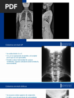Anomalías de Transición Lumbosacra Por Tc. Método Castellvi | PDF ...