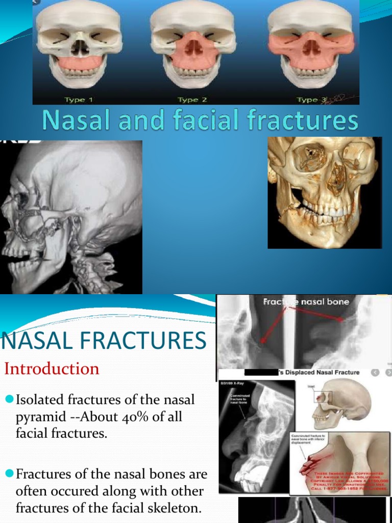 Nasal And Facial Fractures Pdf Human Nose Clinical Medicine