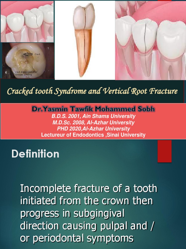 Cracked Tooth Syndrome and Vertical Root Fracture 2 1 1 | Download Free ...