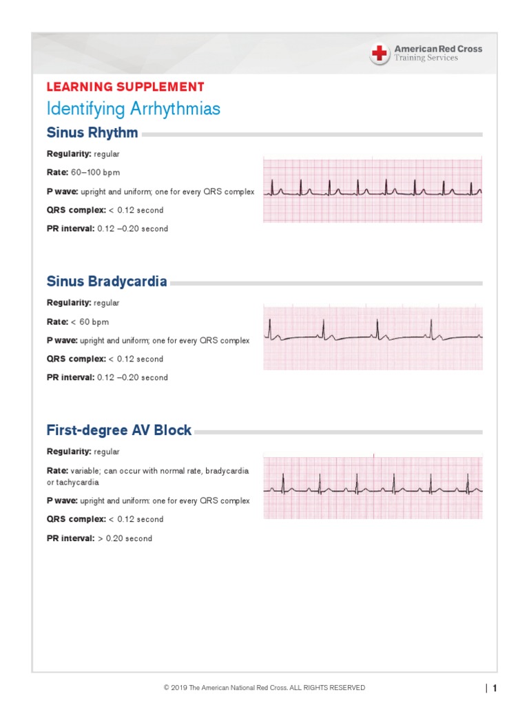 LS Identifying Arrhythmias | PDF
