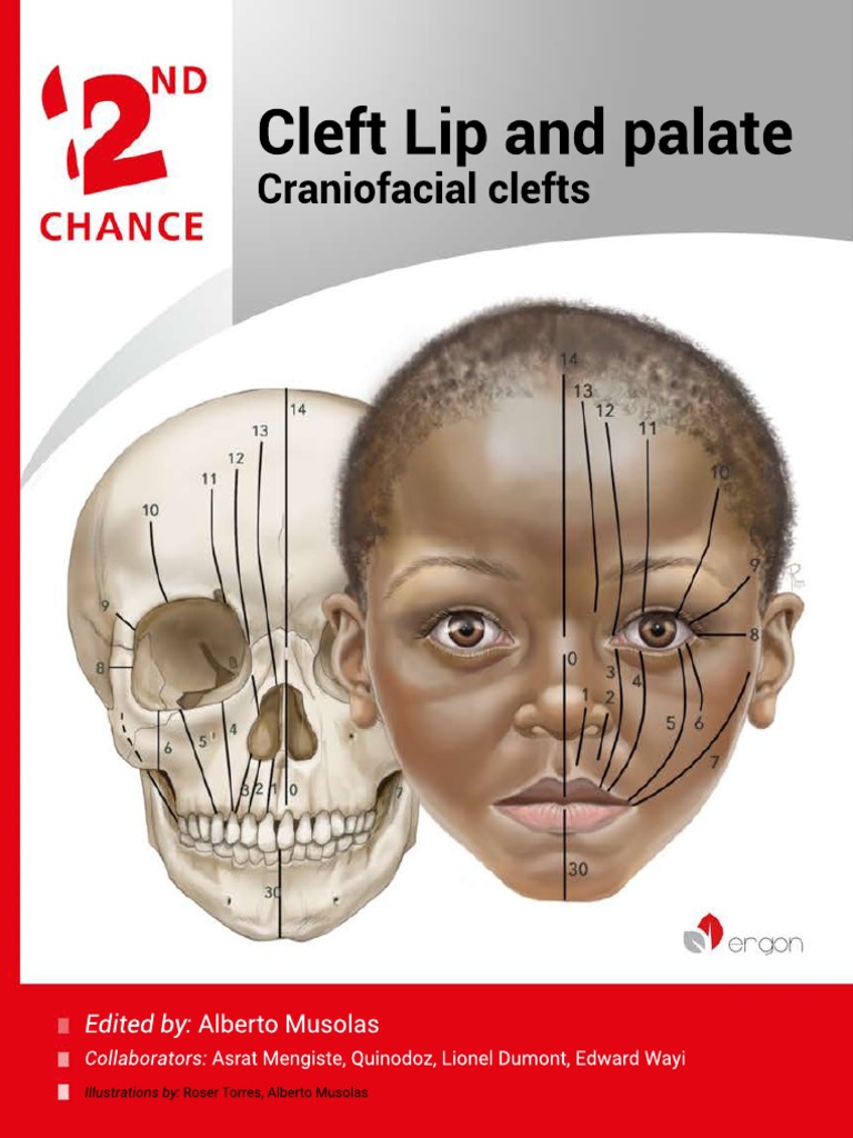 Cleft Lip and Palate - Claniofacial Clefts Book | PDF | Human Nose | Facial Features