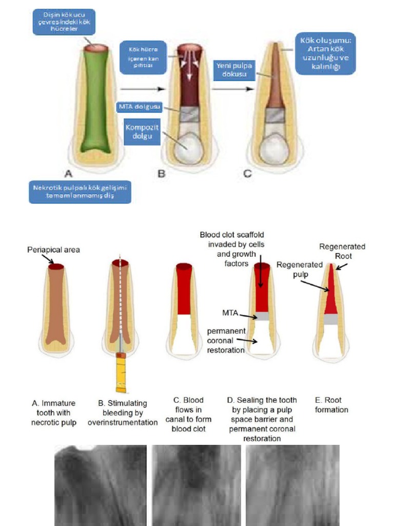 Rejeneratif Endodonti (Görsel) | PDF
