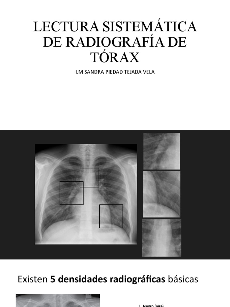Lectura Sistemática de Radiografía de Tórax Im 2023 | PDF | Pulmón | Tórax