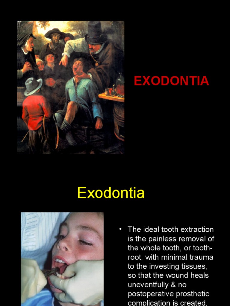 EXODONTIA | PDF