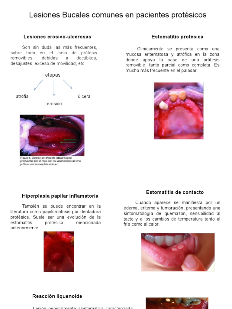 Lesiones Bucales Por Protesis | PDF | Medicina | Ciencias de la Salud
