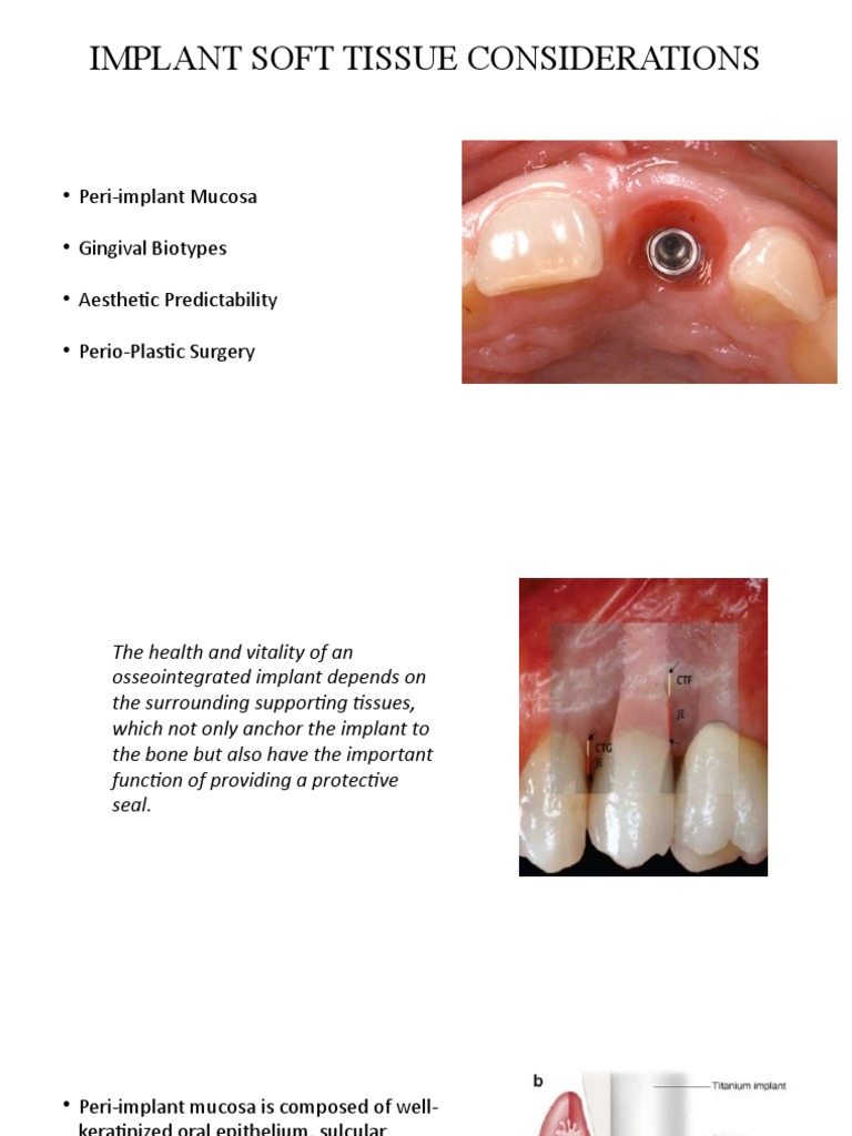 Implant Soft Tissue Considerations | PDF | Dental Implant | Periodontology