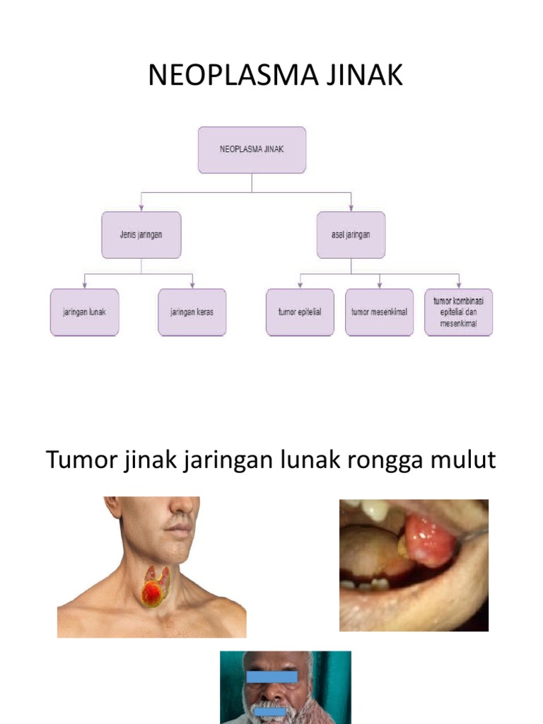 Neoplasma Jinak | PDF