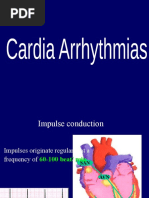 Atrial Fibrillation:Flutter in Pre-Excitation - LITFL - ECG Library ...