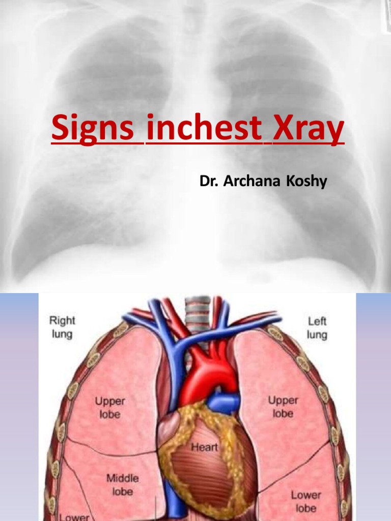 Arch K Signs in Chest Xray 160210003601 | PDF | Lung | Thorax