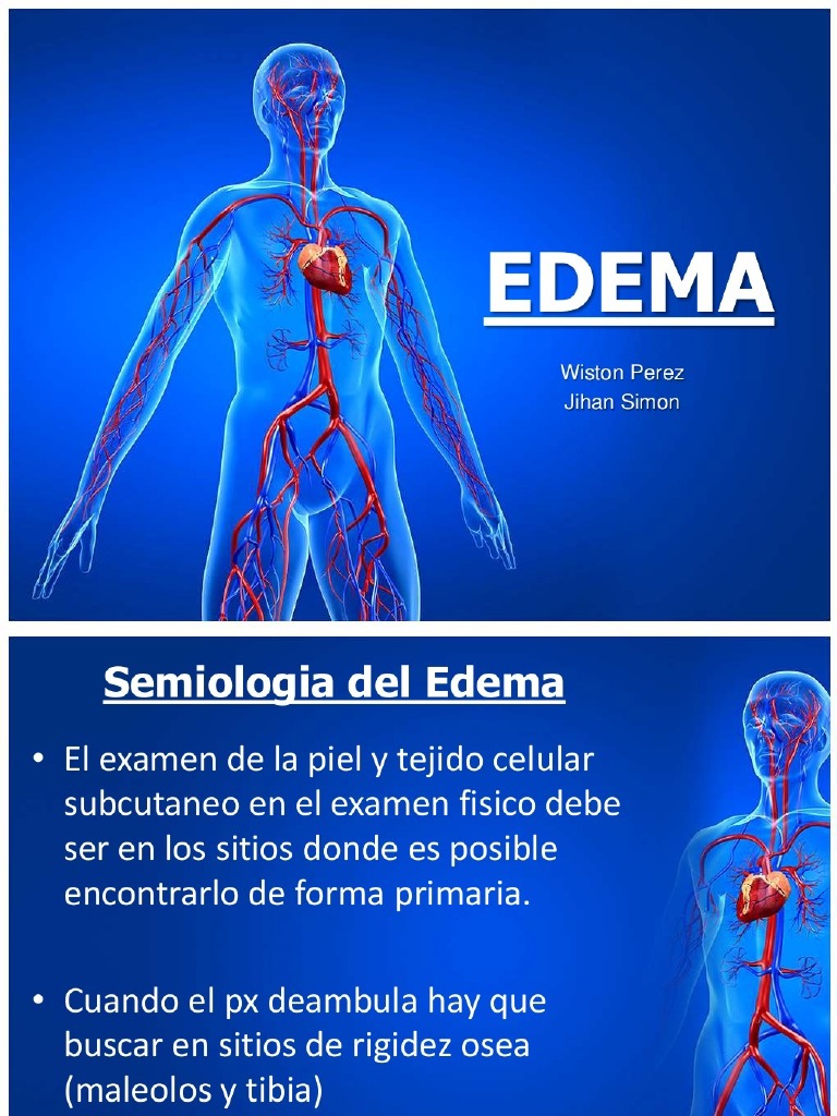 Semiologia Del Edema | PDF