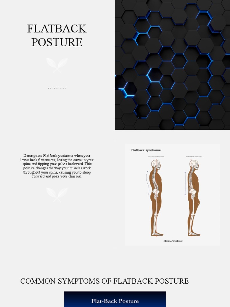Flatback Posture | PDF