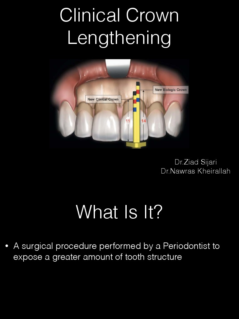 Clinical Crown Lengthening | PDF