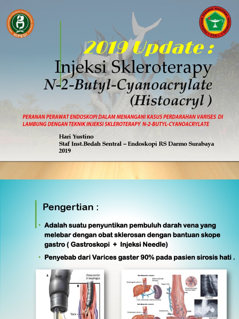 Injeksi Histoacryl untuk Varises Lambung | PDF