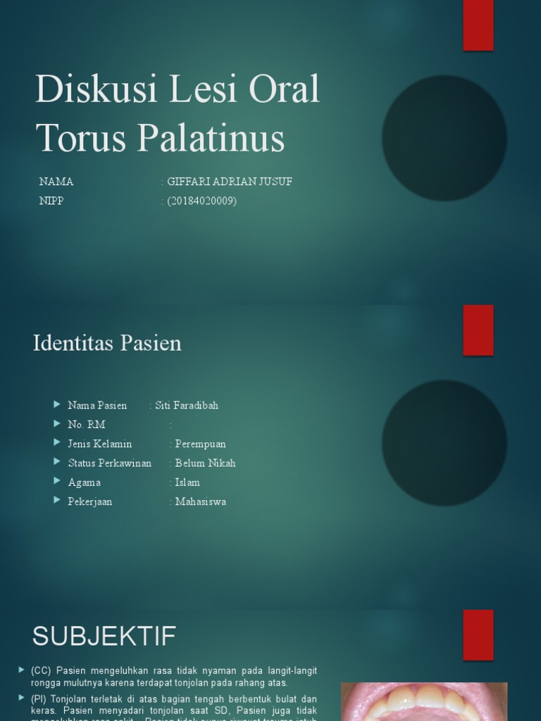 Torus Palatinus | PDF