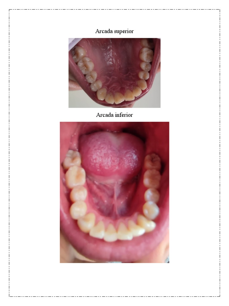 Arcada Superior | PDF