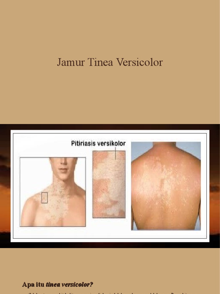 Perawatan Tinea Versicolor pada Dewasa | PDF | Kesehatan Holistik