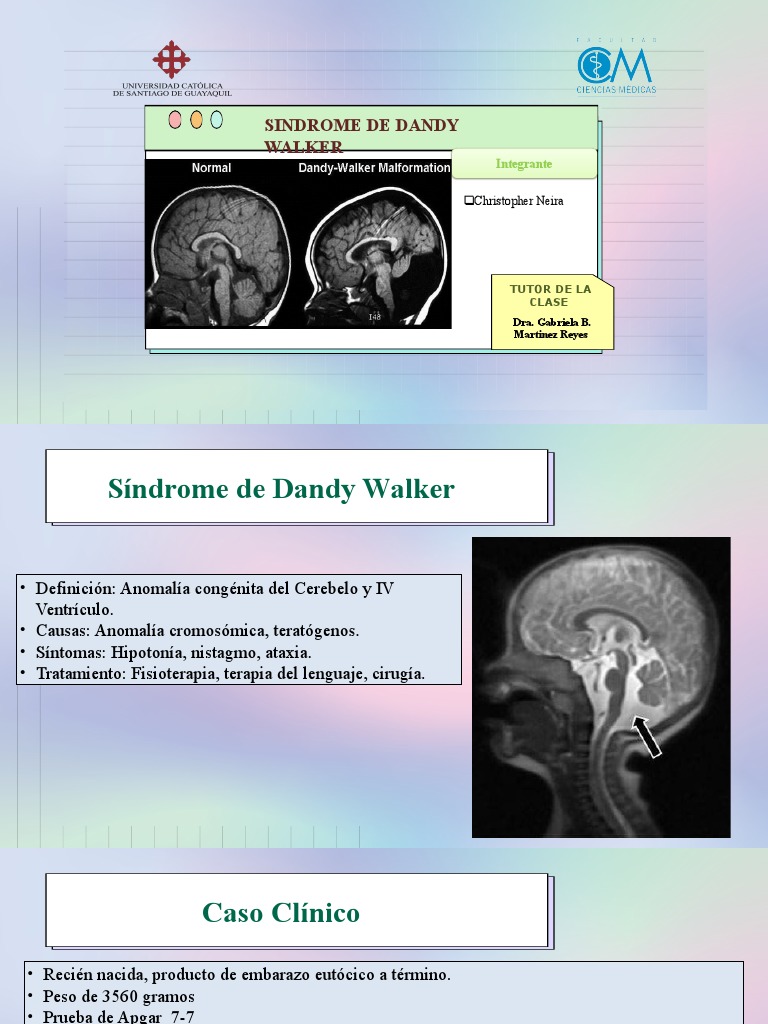 DANDY-WALKER | PDF | Epidemiología | Sistema nervioso