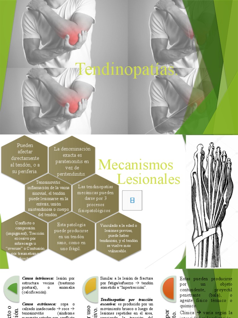 Tendinopatías | PDF