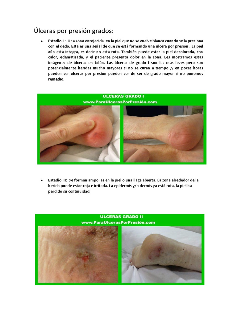 Úlceras Por Presión | PDF