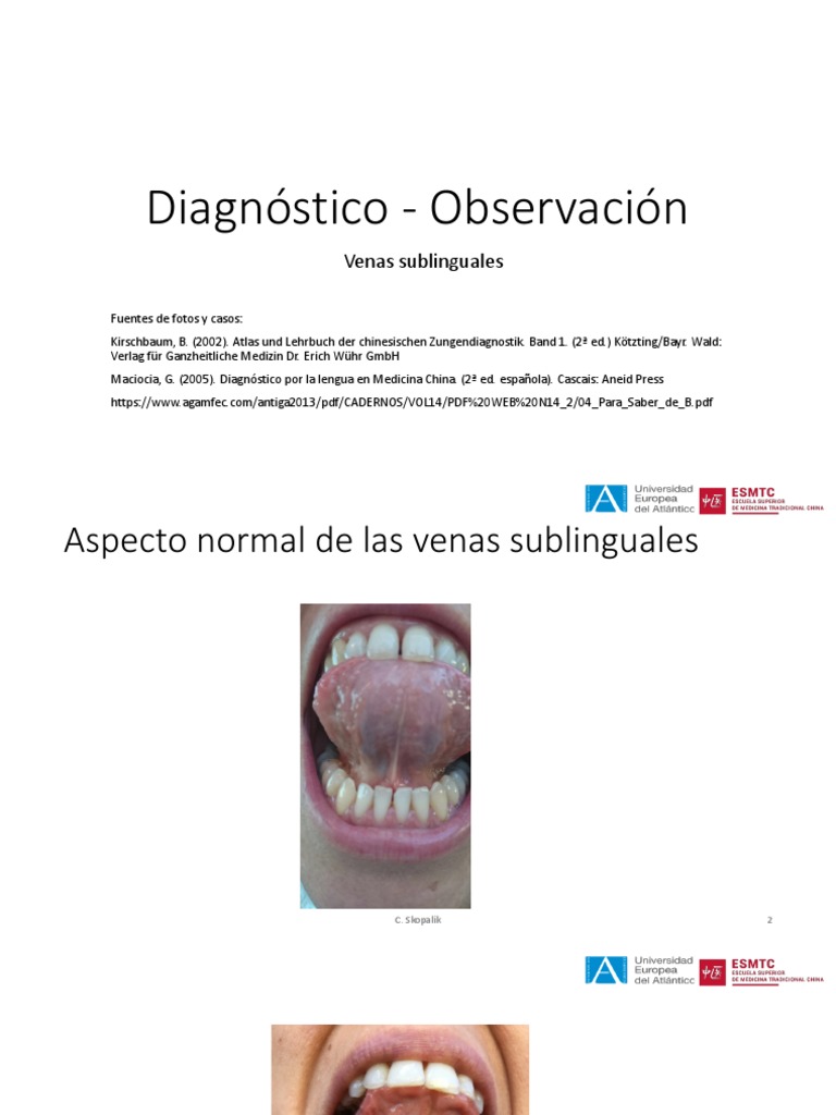 Diagnóstico Por Las Venas Sublinguales | PDF | Cáncer | Metástasis