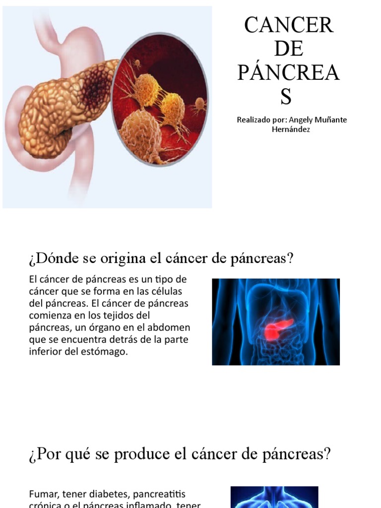 Cáncer de páncreas: síntomas y diagnóstico | PDF | Cáncer de páncreas ...
