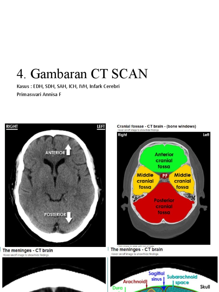 CT Scan Analysis: EDH, SDH, SAH | PDF | Human Head And Neck | Central ...