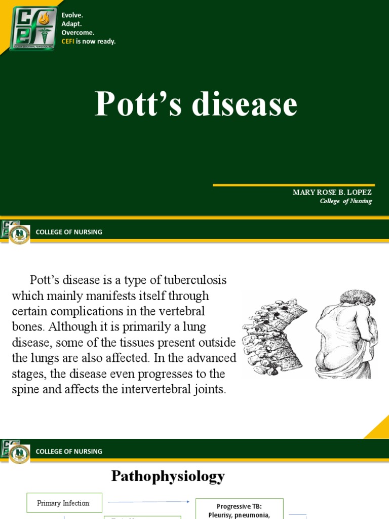 Potts Disease | PDF