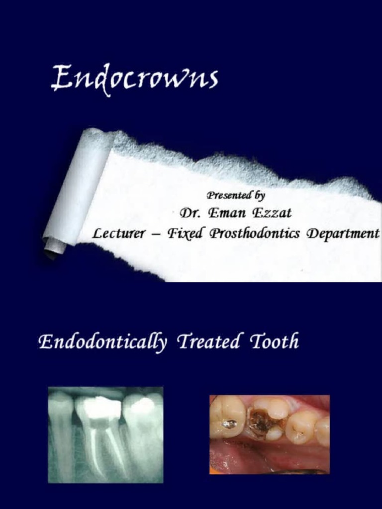 Endocrown Lecture | PDF