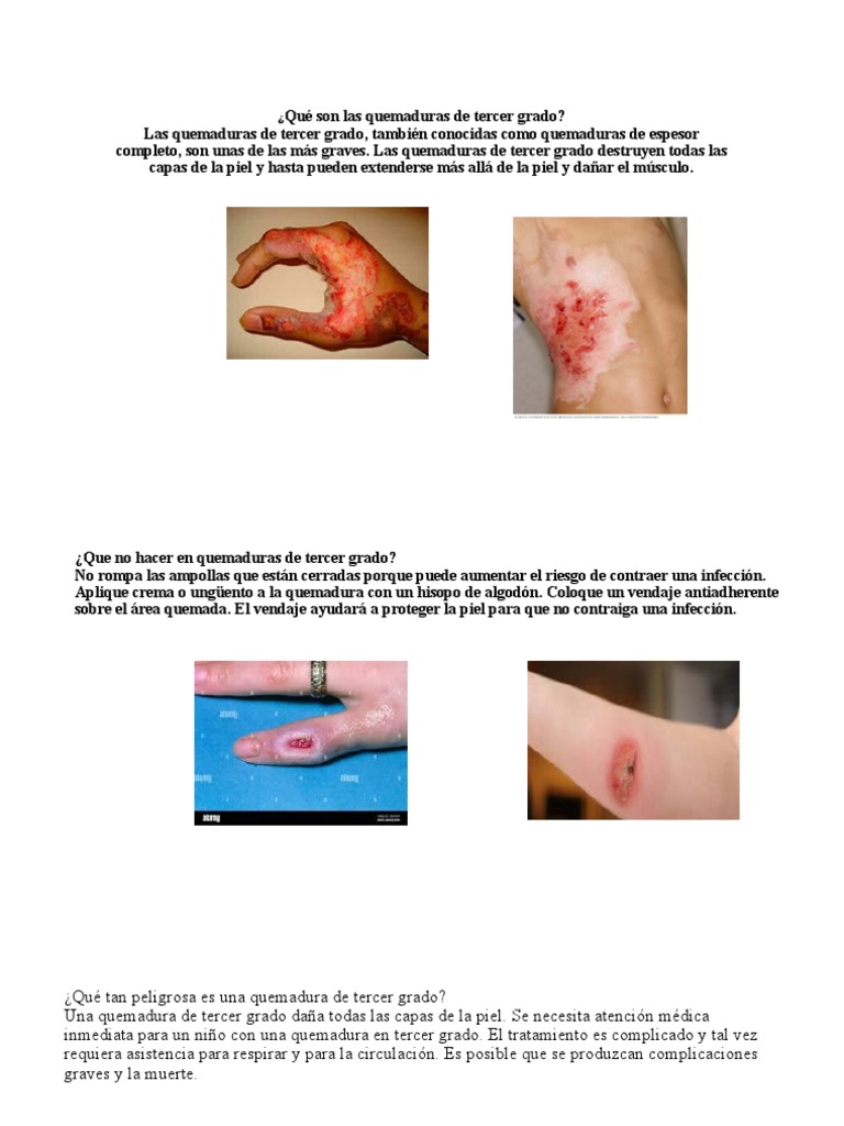 Qué Son Las Quemaduras de Tercer Grado | PDF