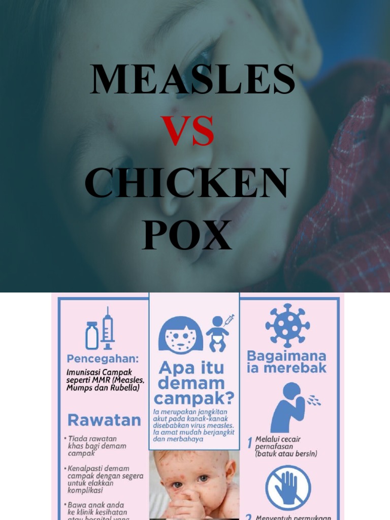 Measles VS Chicken Pox | PDF
