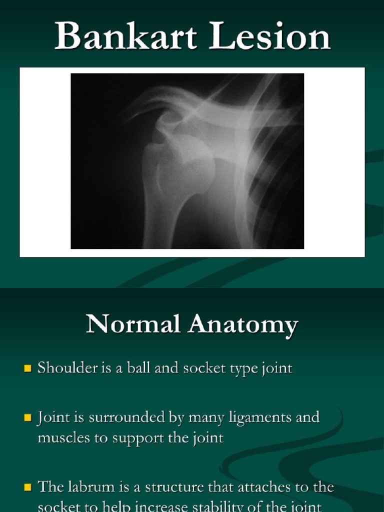 Bankart Lesion Thomas J Kovack Do PPT Download | PDF