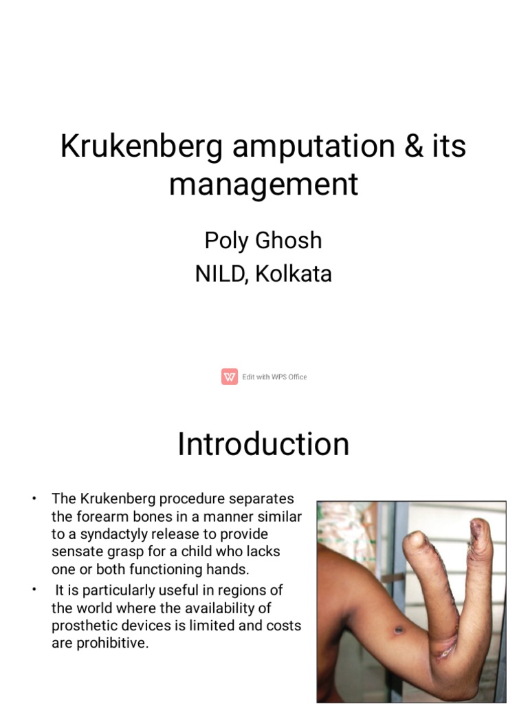 Krukenberg Amputation & Its Management | PDF | Prosthesis | Medical ...