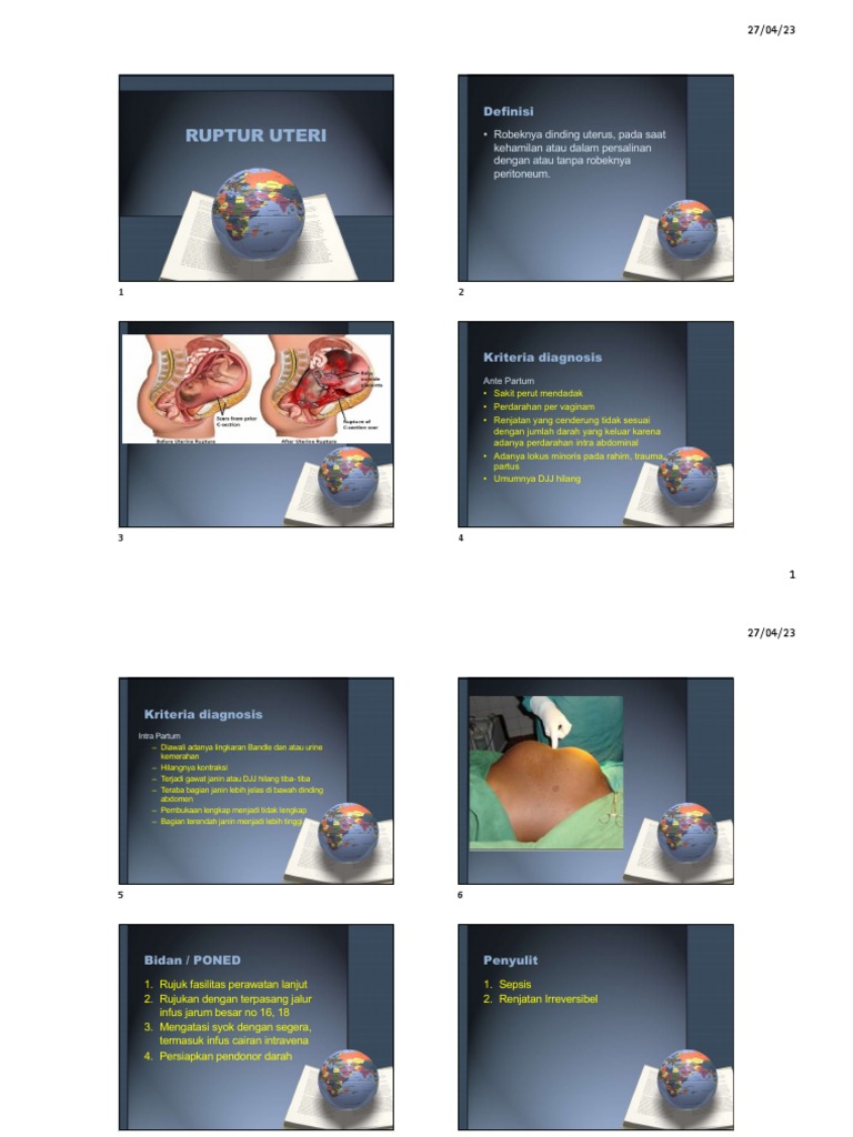 Ruptur Uterus | PDF