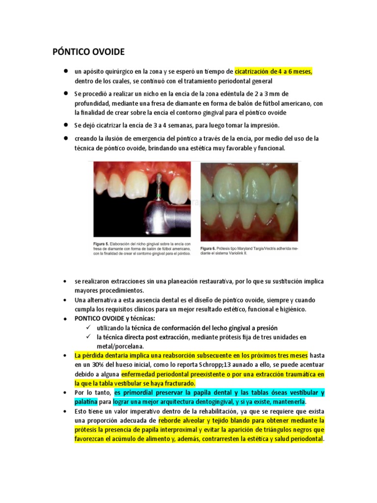 Diseño y técnica del póntico ovoide | PDF | Dentadura postiza ...