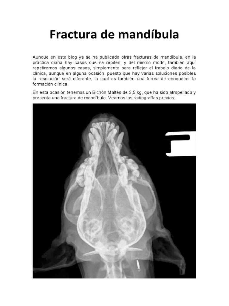 116- Fractura de mandíbula | PDF