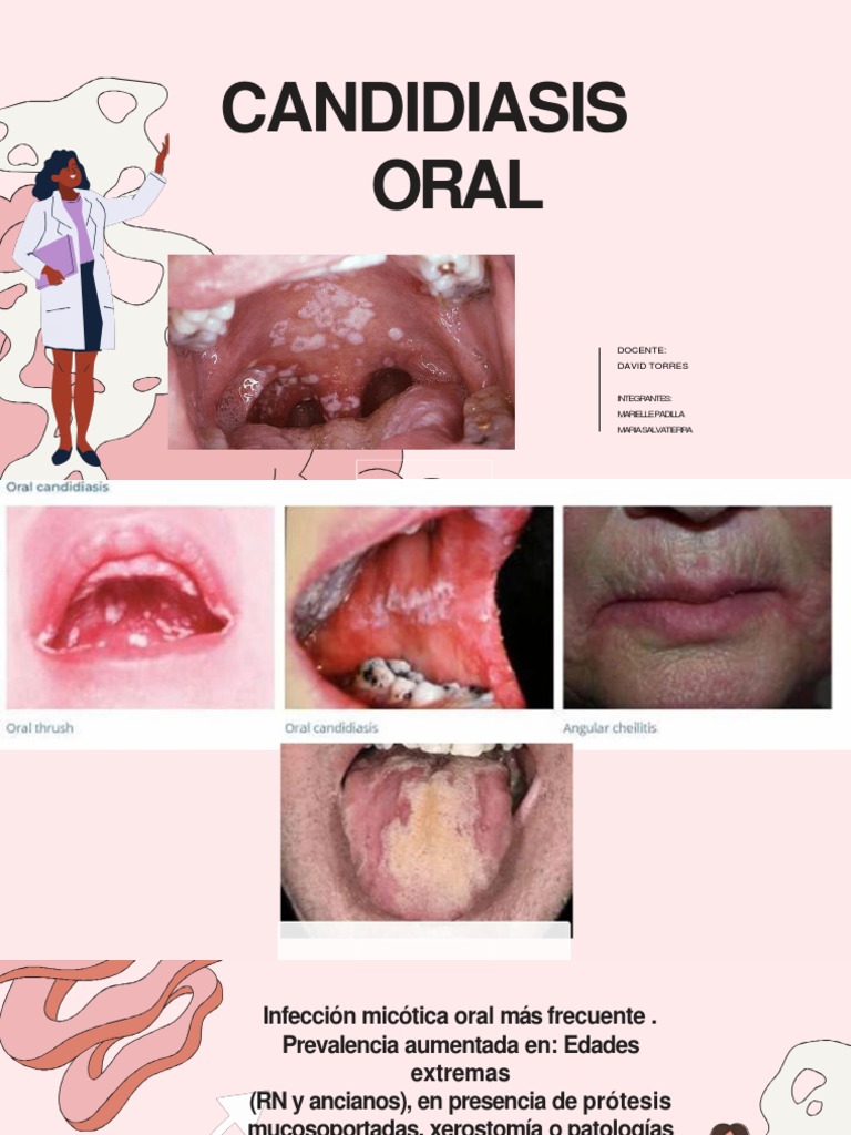 CANDIDIASIS BUCAL | PDF | Candidiasis | Inmunología