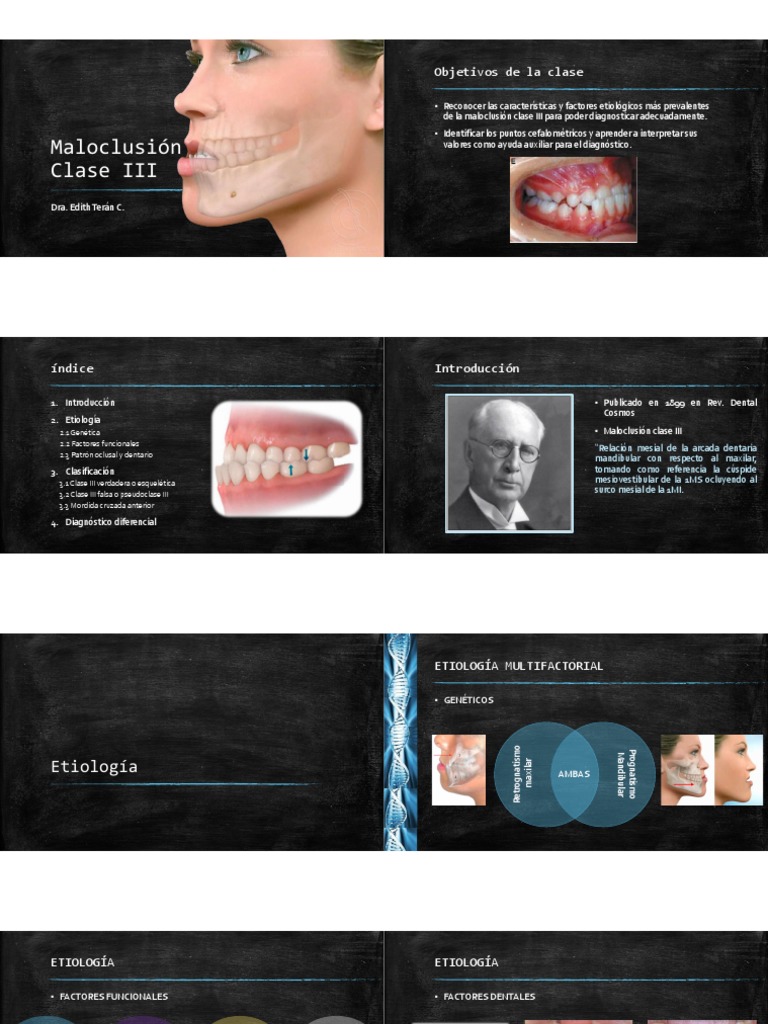 Maloclusión Clase III | PDF | Ramas de Odontología | Anatomia dental