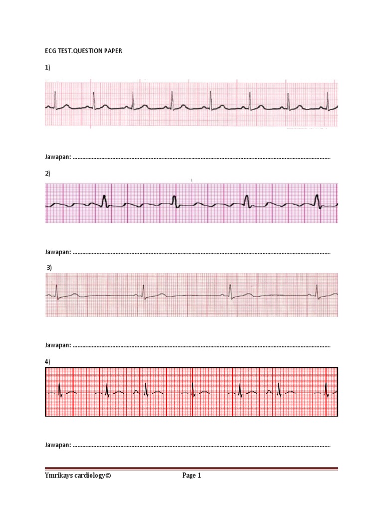 Ecg Test | PDF