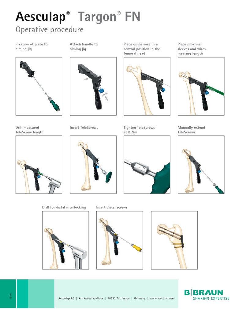 targon-fn-operativeprocedure | PDF