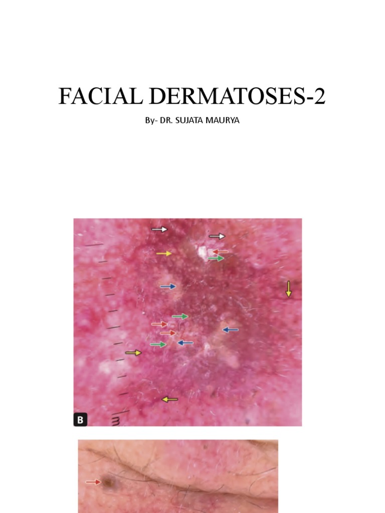 Facial Dermatoses-2 Pics | PDF