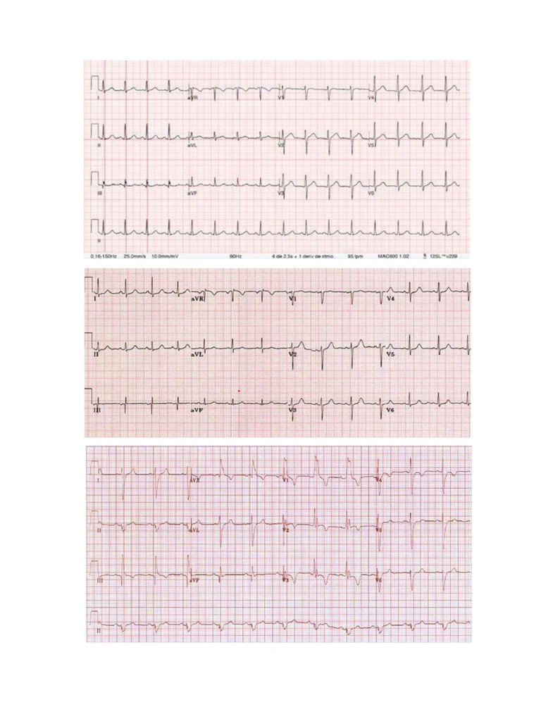 EKG EXAMPLE | PDF