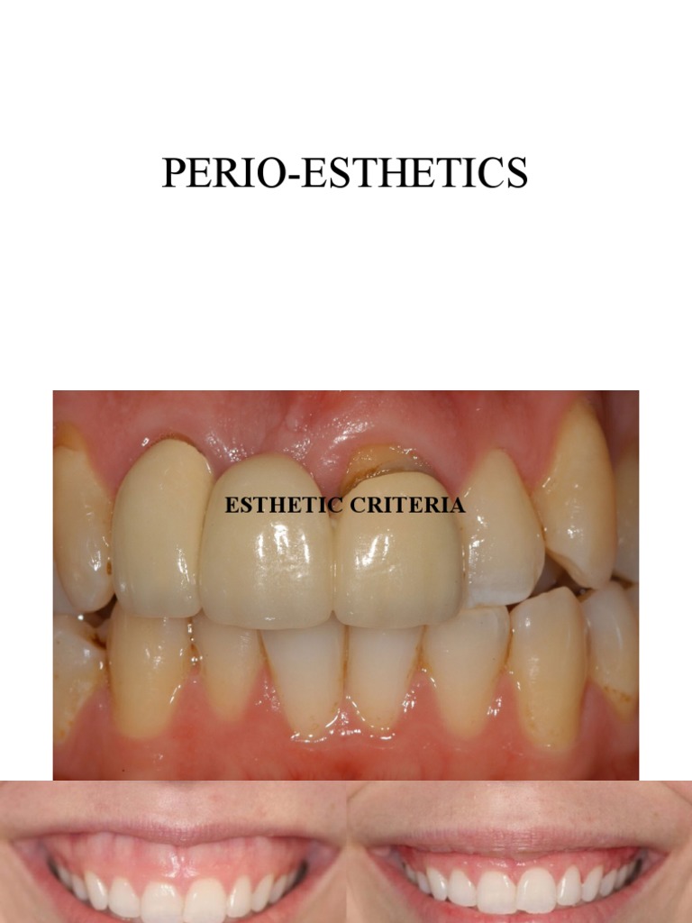 Perio-Esthetics | PDF