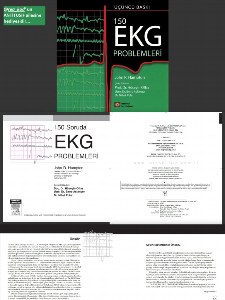 150 Ekg | PDF